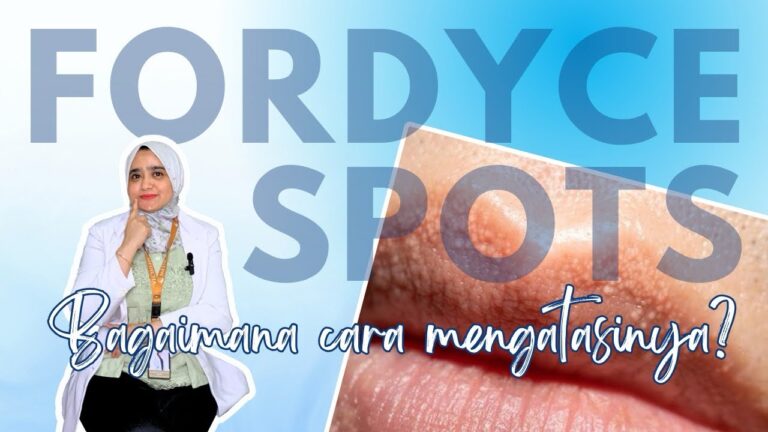 Mengungkap Rahasia Fordyce Spots: Apa yang Harus Anda Ketahui dan ...
